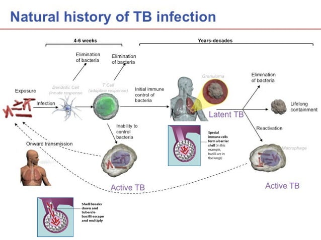 Basic pulmonary tuberculosis intro | PPT
