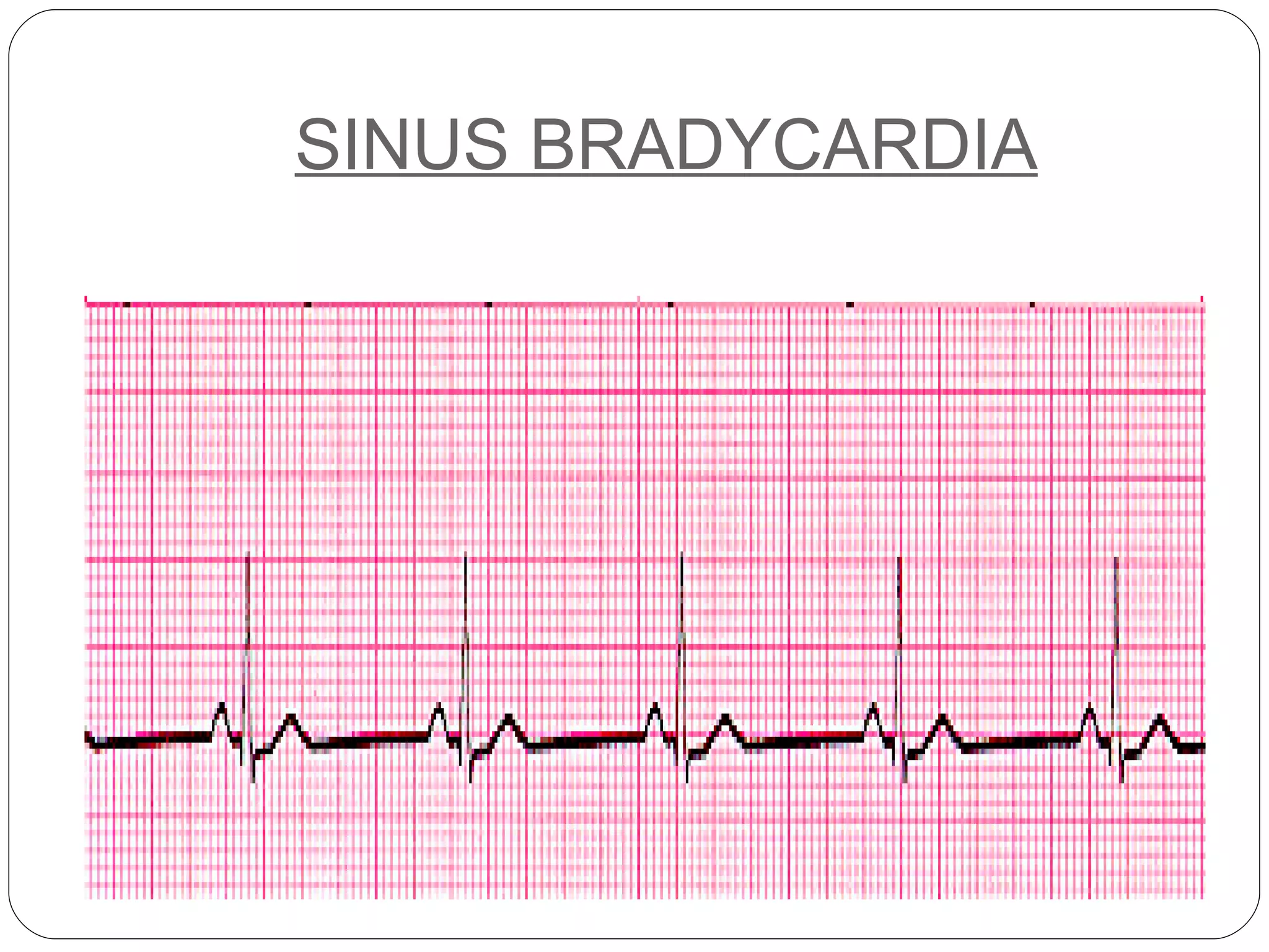 Basics of ECG | PPT