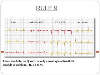 Basics of ECG | PPT