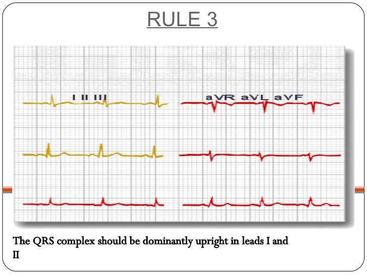 Basics of ECG
