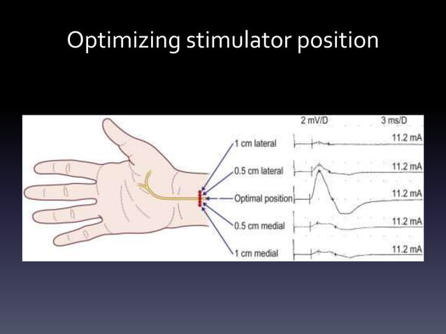 ncs study - basics of nerve conduction study | PPTX | Brain and Nervous ...