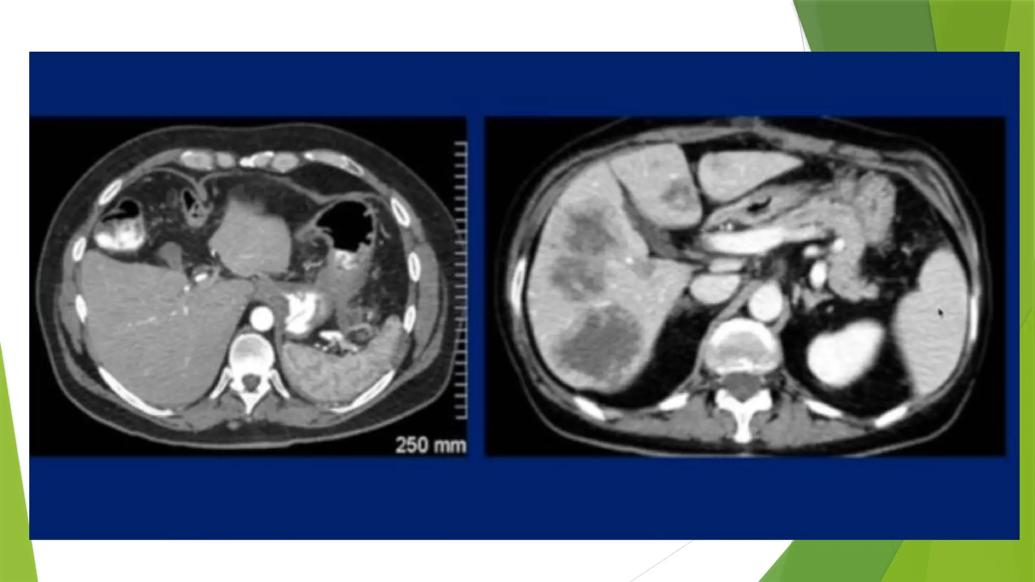 BASICS AND PRINCIPLES OF CT SCAN and windowing.pptx