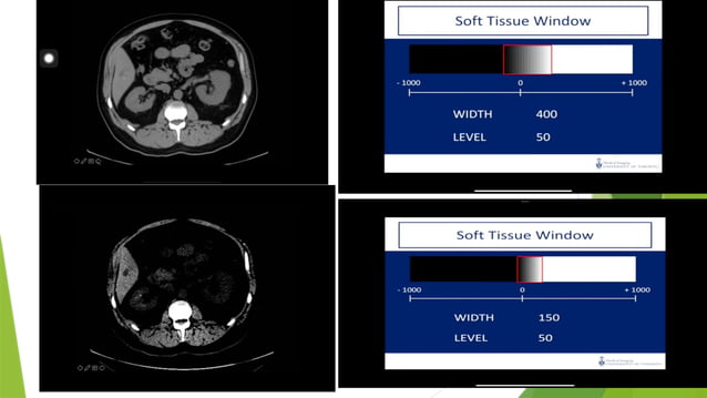 BASICS AND PRINCIPLES OF CT SCAN and windowing.pptx
