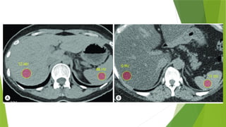 BASICS AND PRINCIPLES OF CT SCAN and windowing.pptx