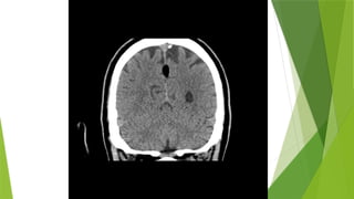 BASICS AND PRINCIPLES OF CT SCAN and windowing.pptx