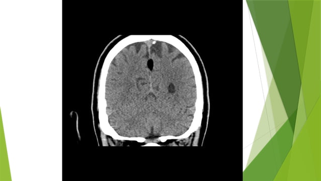 BASICS AND PRINCIPLES OF CT SCAN and windowing.pptx