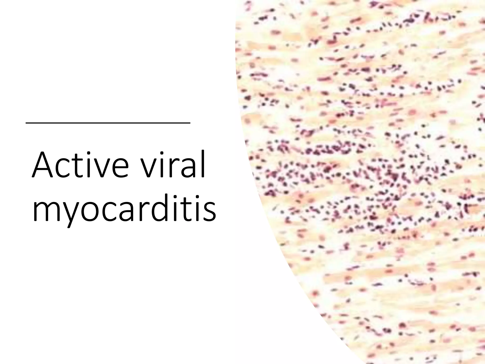 Basic science and forensic pathology aspects of myocarditis | PPTX