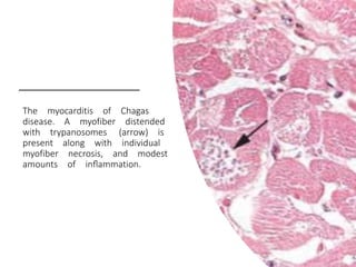 Basic science and forensic pathology aspects of myocarditis | PPTX