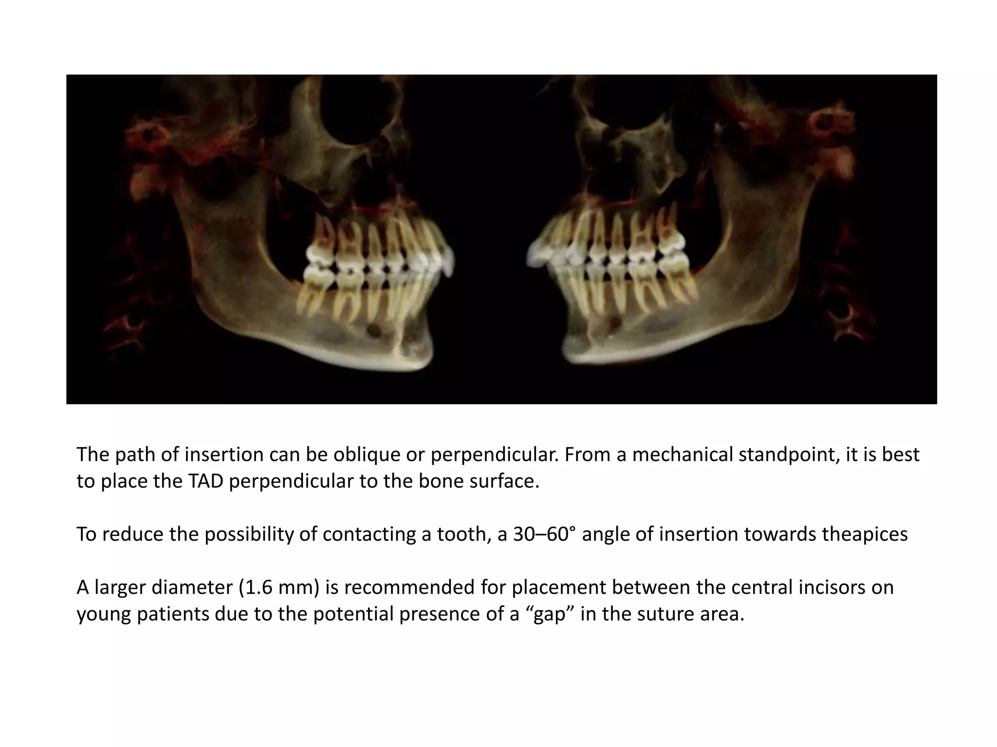BASICS IN BIOMECHANICS OF TSADs.pptx