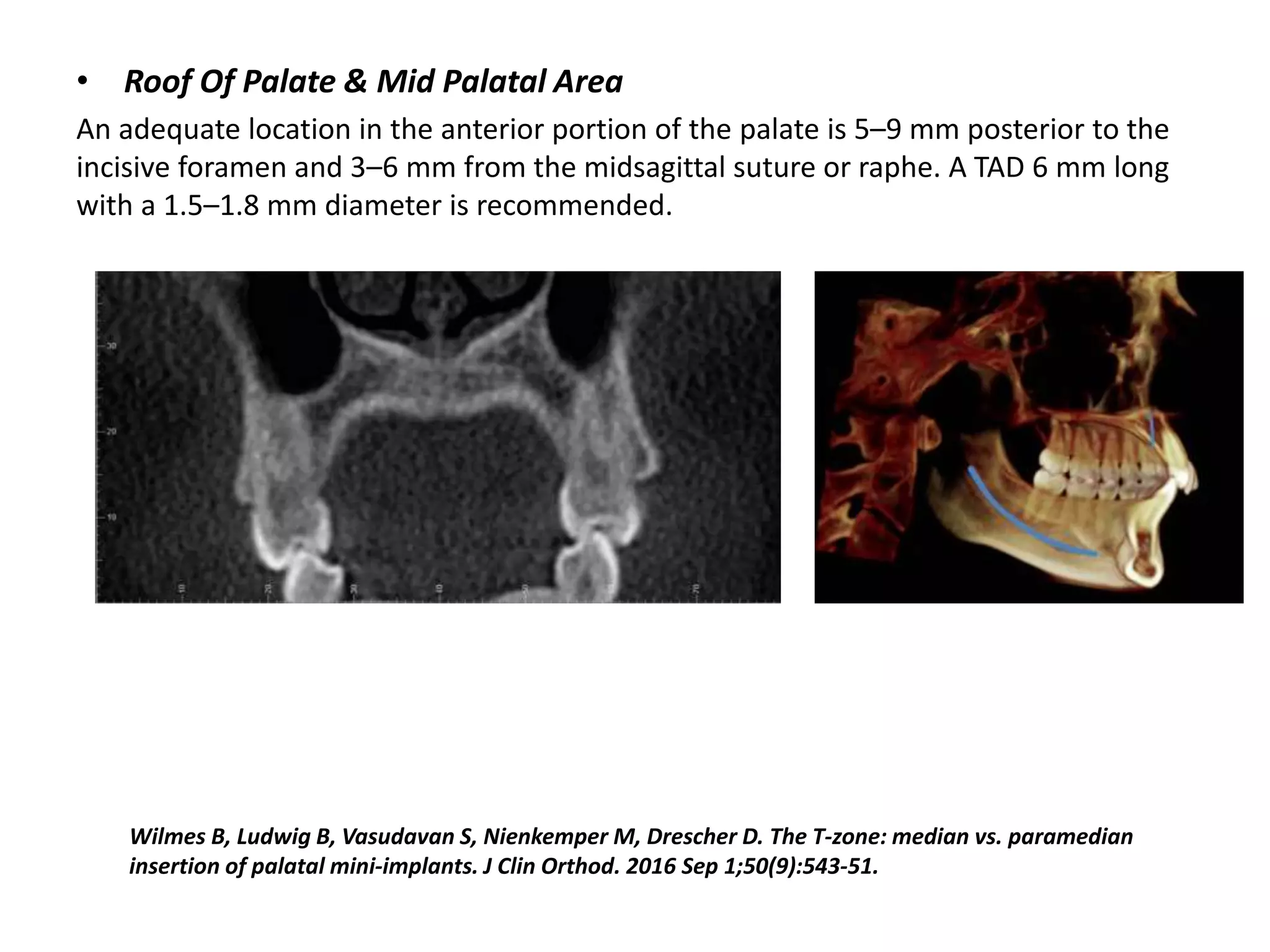 BASICS IN BIOMECHANICS OF TSADs.pptx