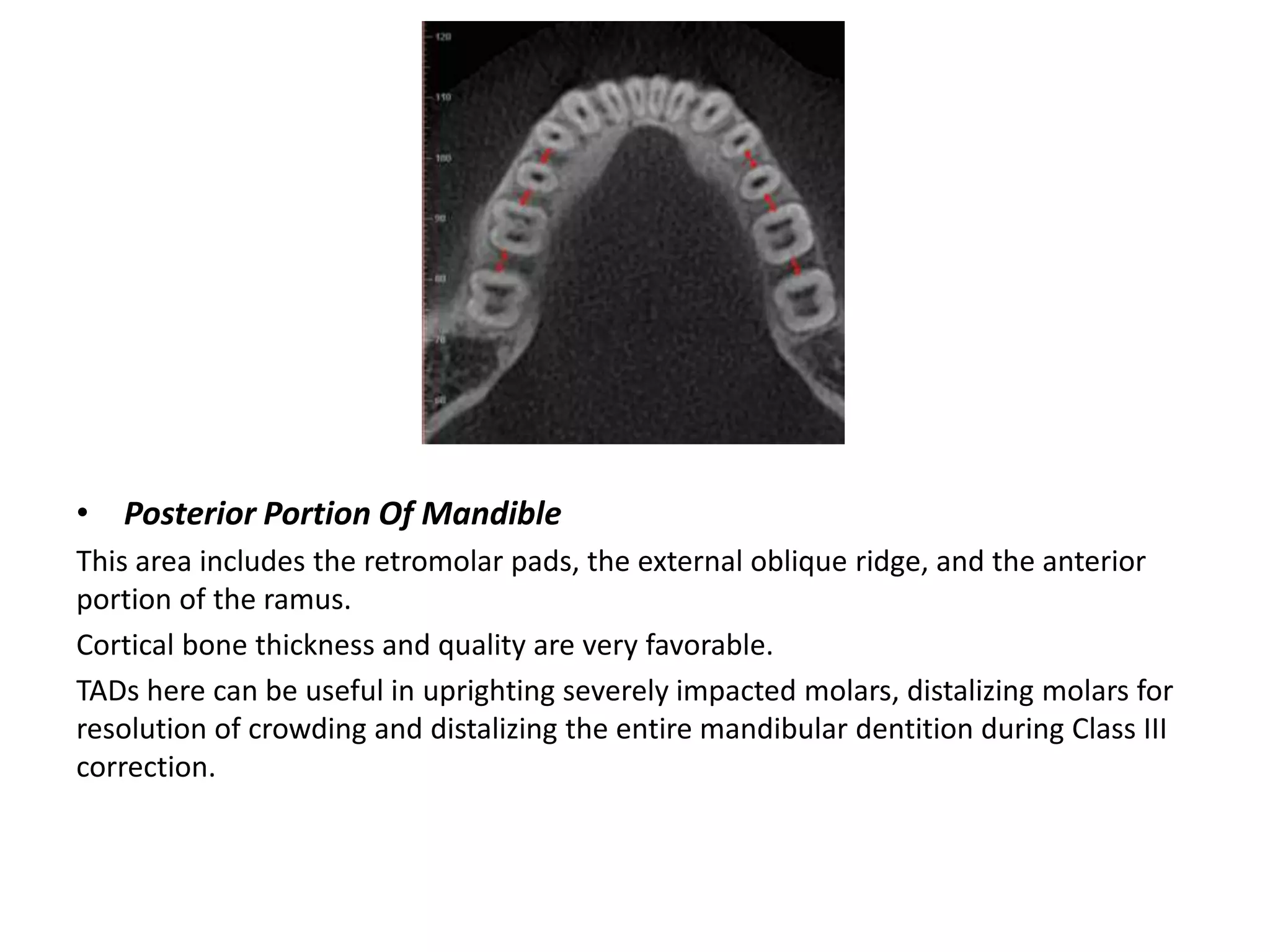 BASICS IN BIOMECHANICS OF TSADs.pptx