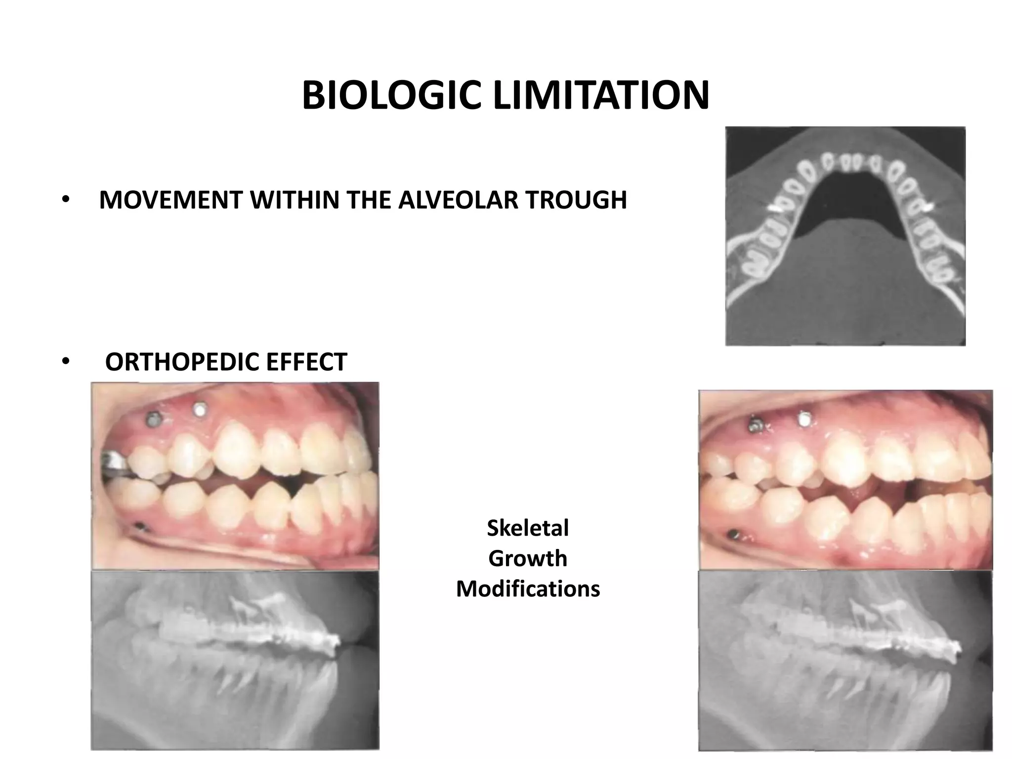 BASICS IN BIOMECHANICS OF TSADs.pptx