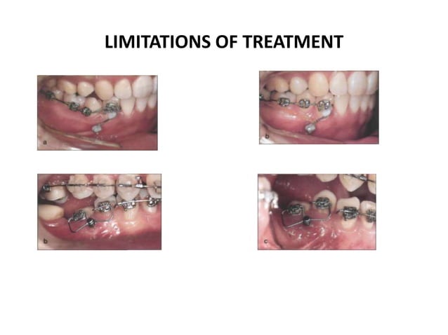 BASICS IN BIOMECHANICS OF TSADs.pptx