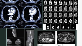 Basics in CT/ Computed Tomography / CT generations/ Computed Tomography working principle ...