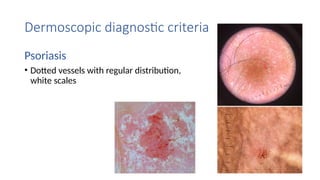 BASICS IN DERMOSCOPY for clinical diagnosis | PPTX