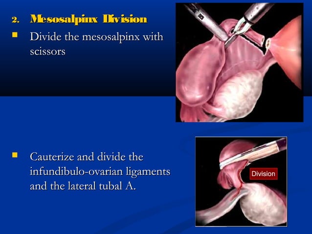 Basics in gyne laparoscopy | PPT