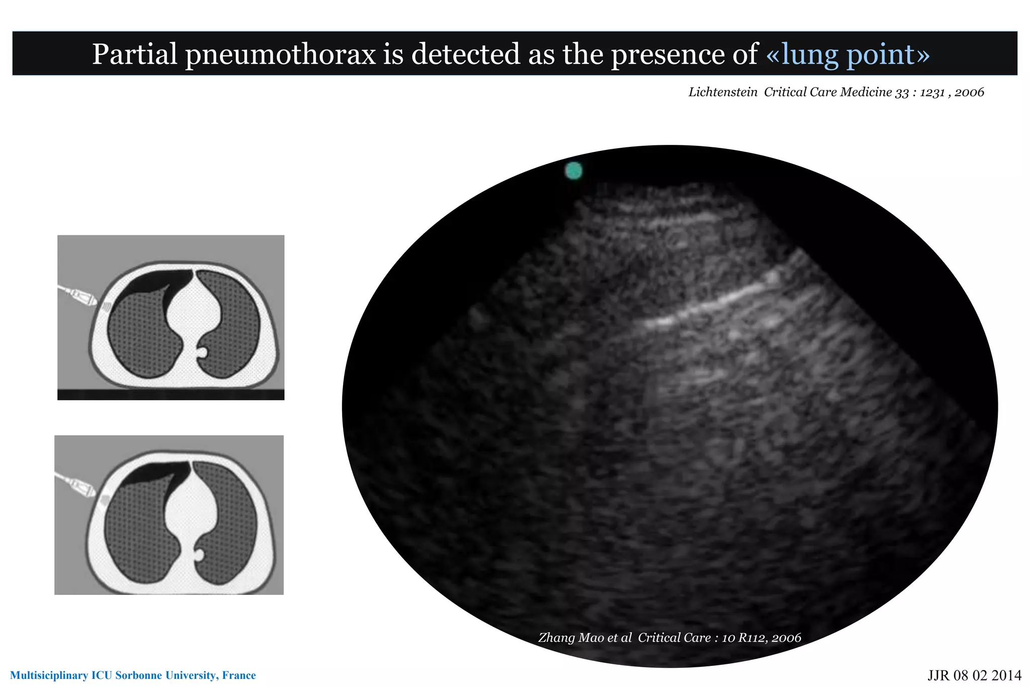 Basic skills in transthoracic lung ultrasound | PPT