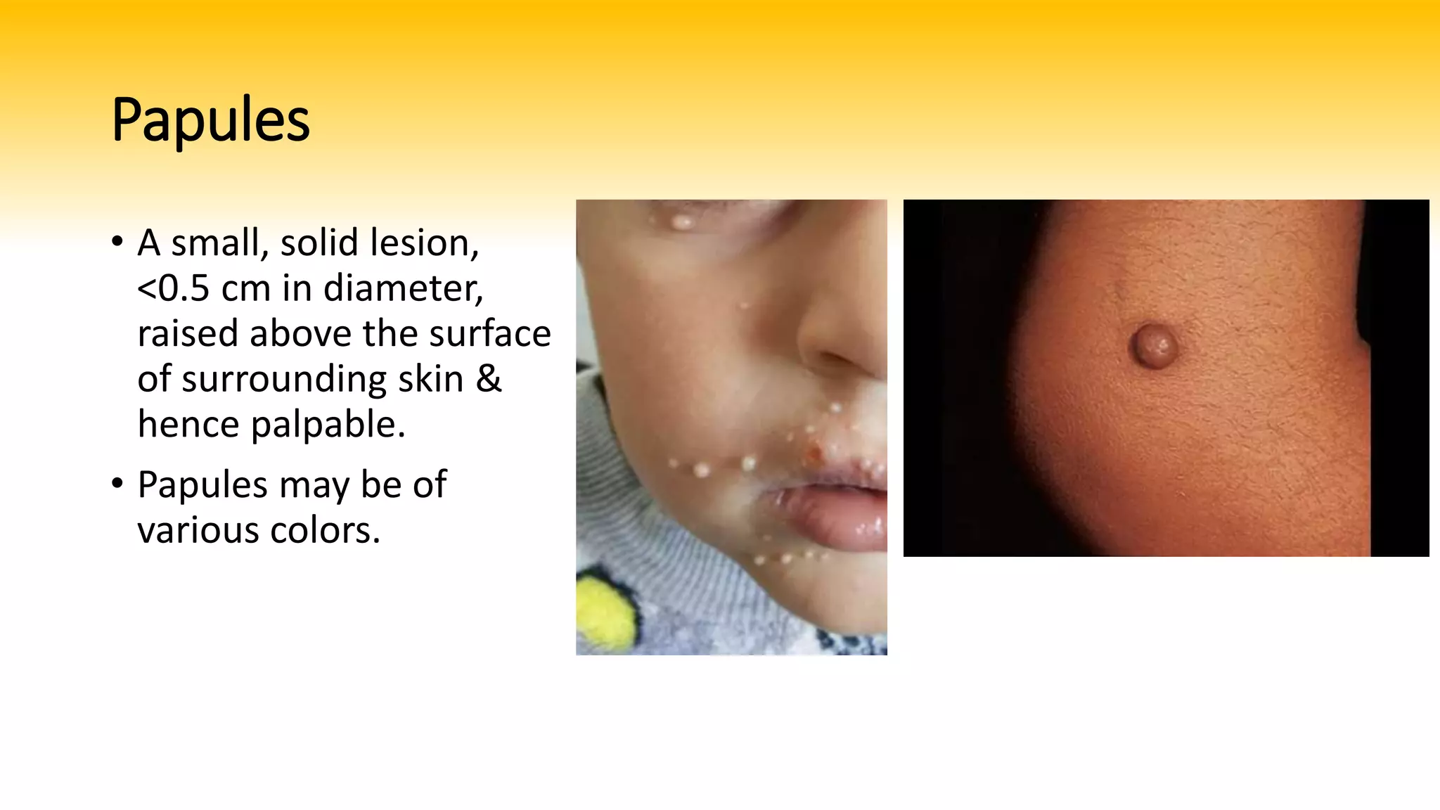 Basic skin lesions | PPTX
