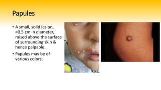 Basic skin lesions | PPTX