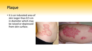 Basic skin lesions | PPTX