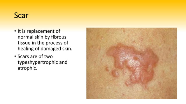 Basic skin lesions | PPTX | Skin and Dermatology | Diseases and Conditions