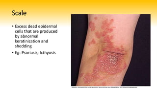 Scale Skin Lesion