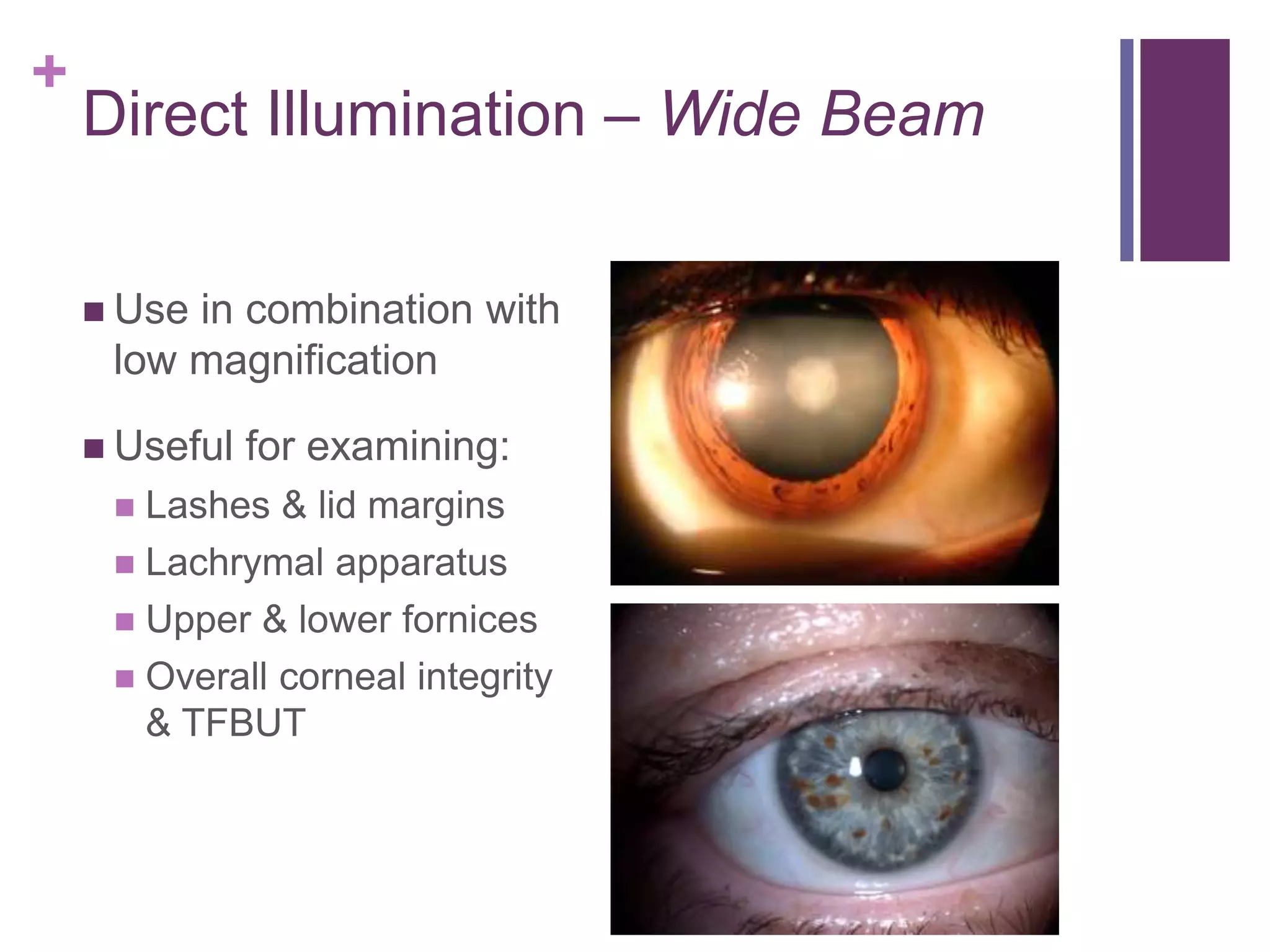Basic Slit Lamp Biomicroscopy | PPTX