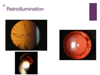 Basic Slit Lamp Biomicroscopy | PPTX