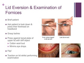 Basic Slit Lamp Biomicroscopy | PPTX