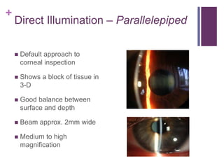 Corneal Parallelepiped