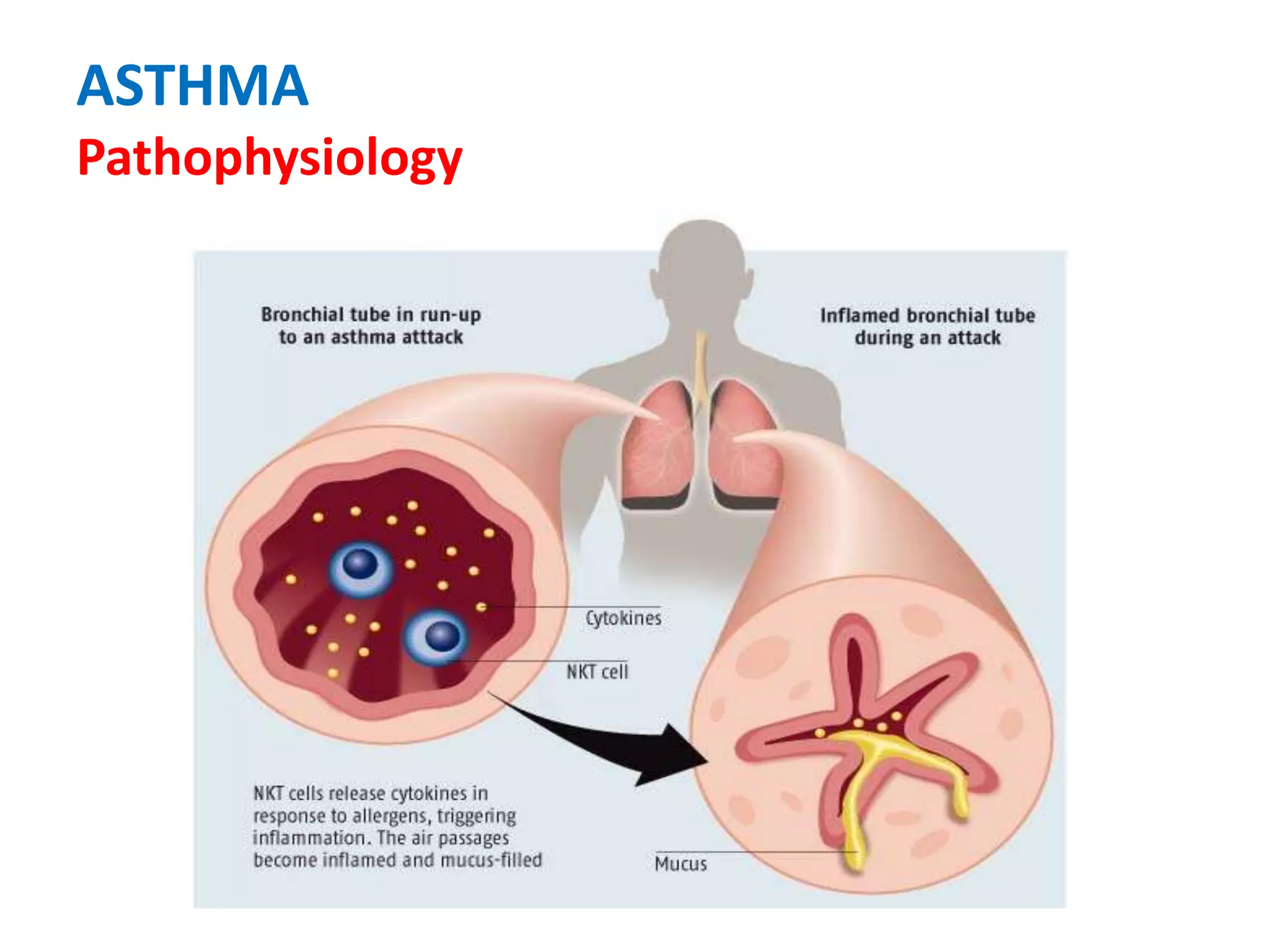 Basics of Bronchial asthma by Dr Qurban Hussain | PPTX