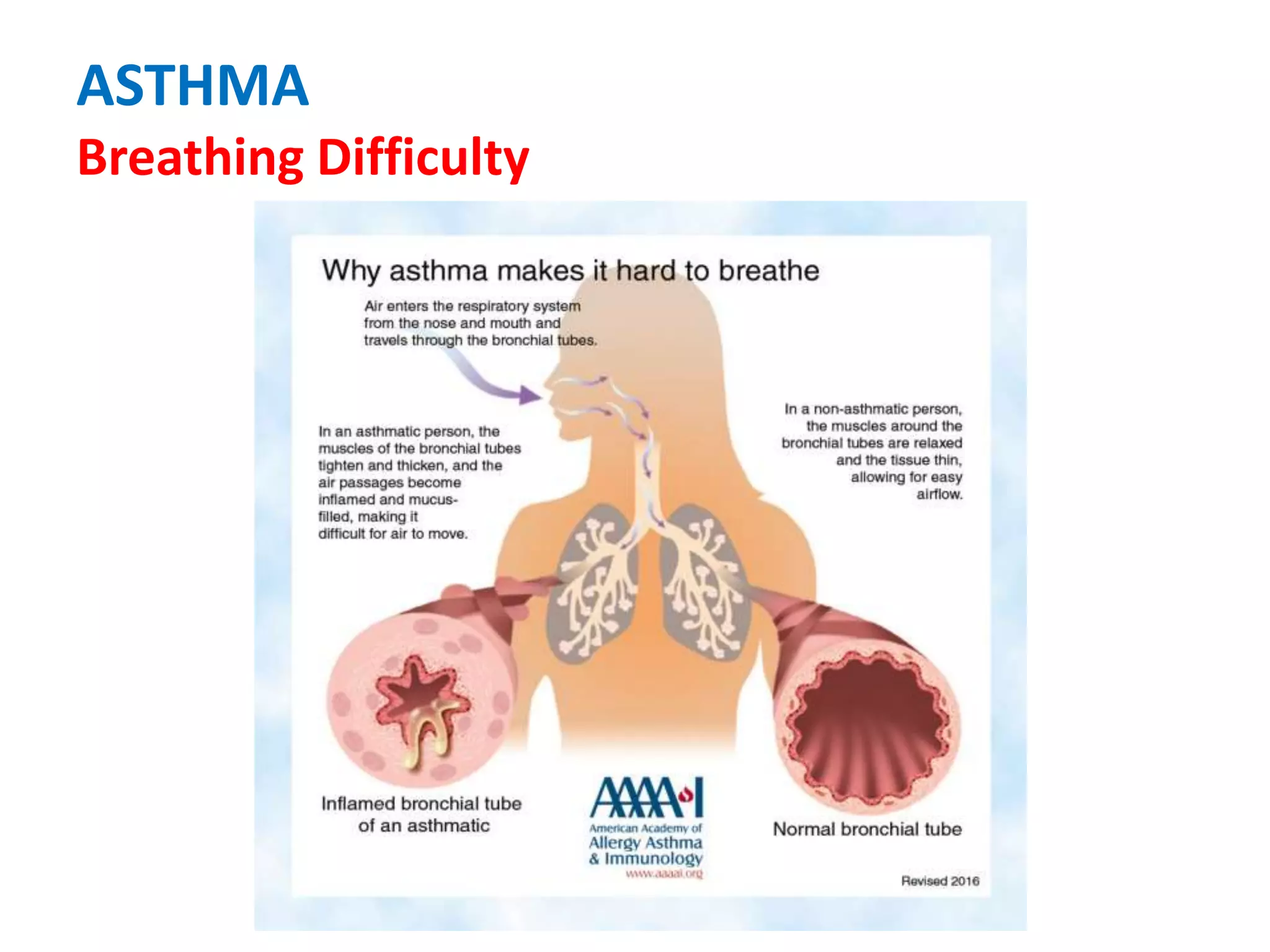 Basics of Bronchial asthma by Dr Qurban Hussain | PPTX