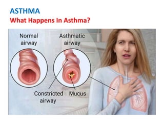 Basics of Bronchial asthma by Dr Qurban Hussain | PPTX