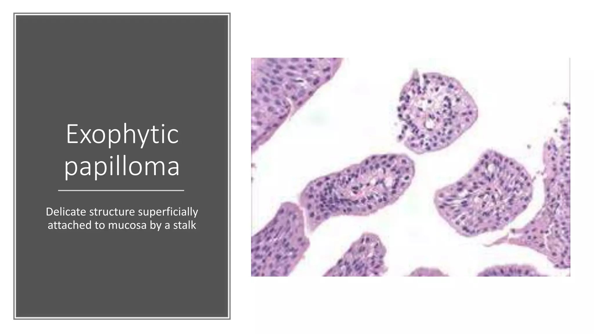 Basics of bladder tumors | PPTX