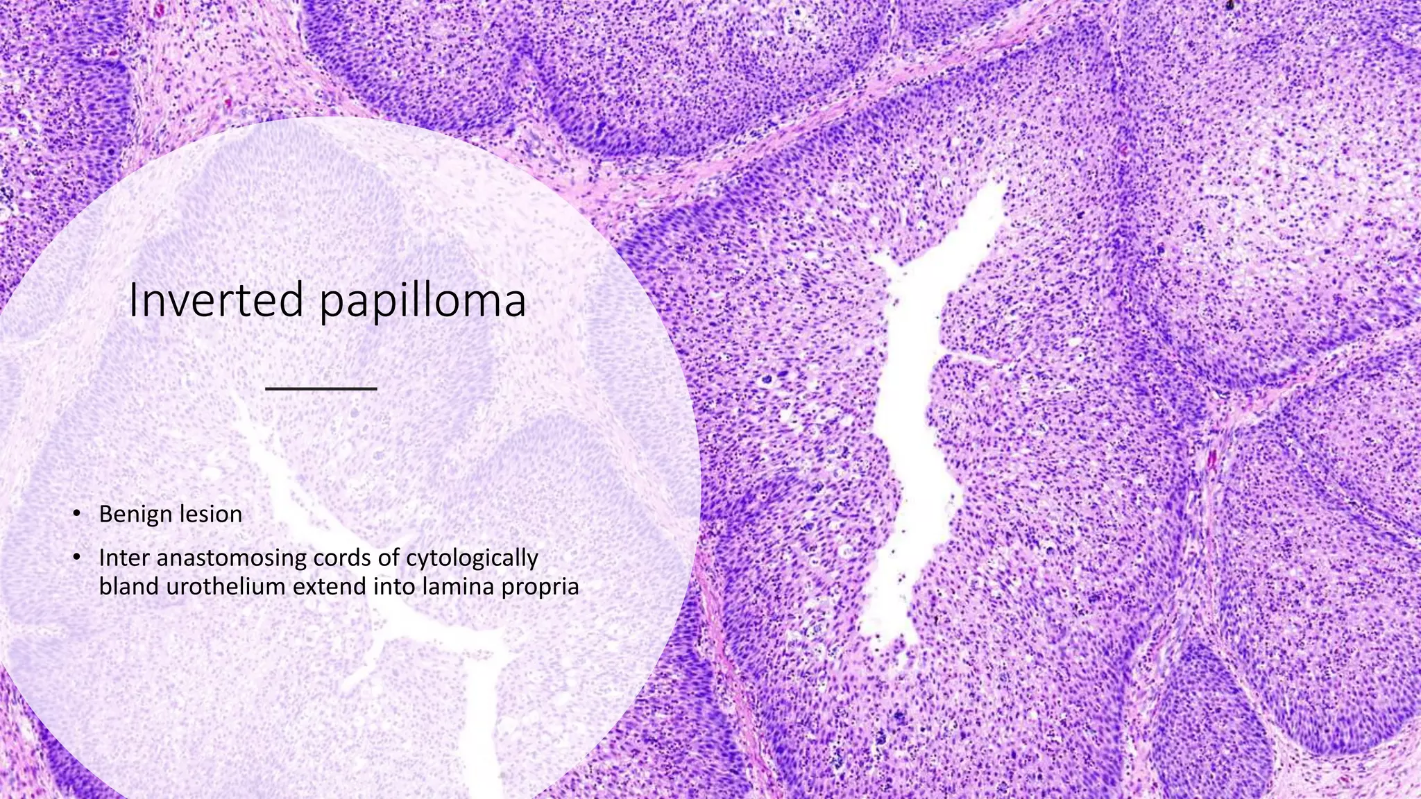 Basics of bladder tumors | PPTX