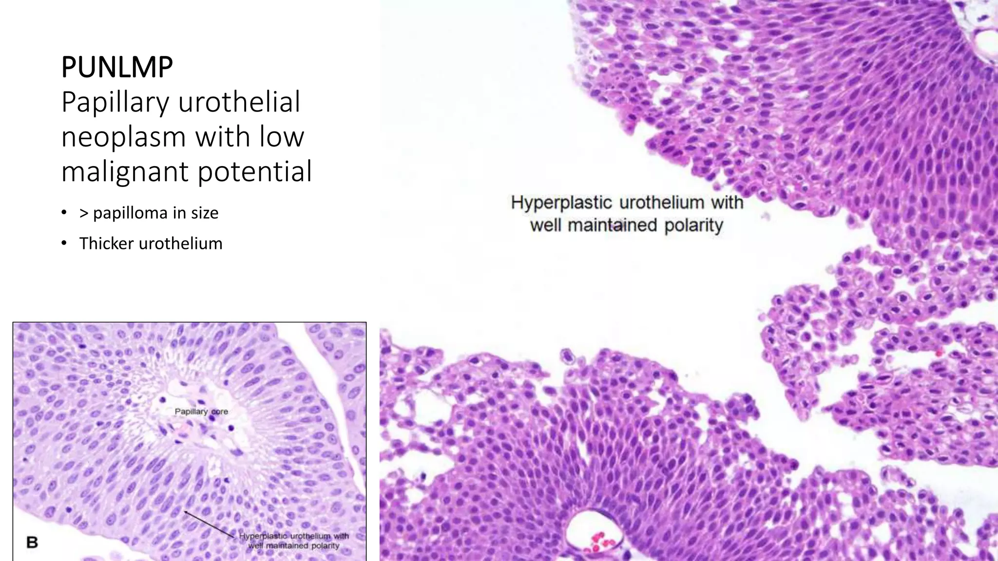 Basics of bladder tumors | PPTX