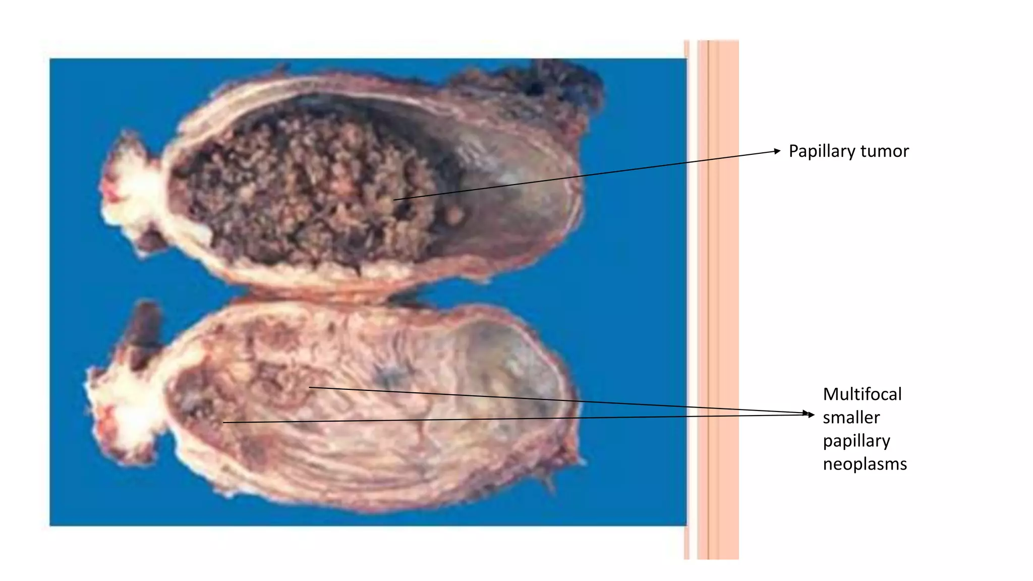 Basics of bladder tumors | PPTX