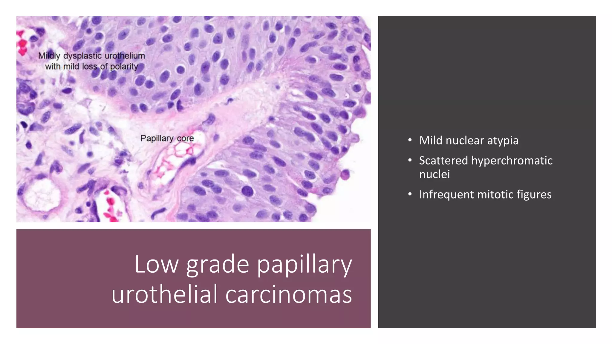 Basics of bladder tumors | PPTX