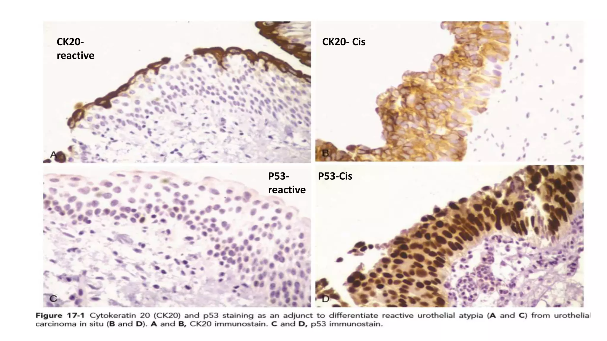 Basics of bladder tumors | PPTX