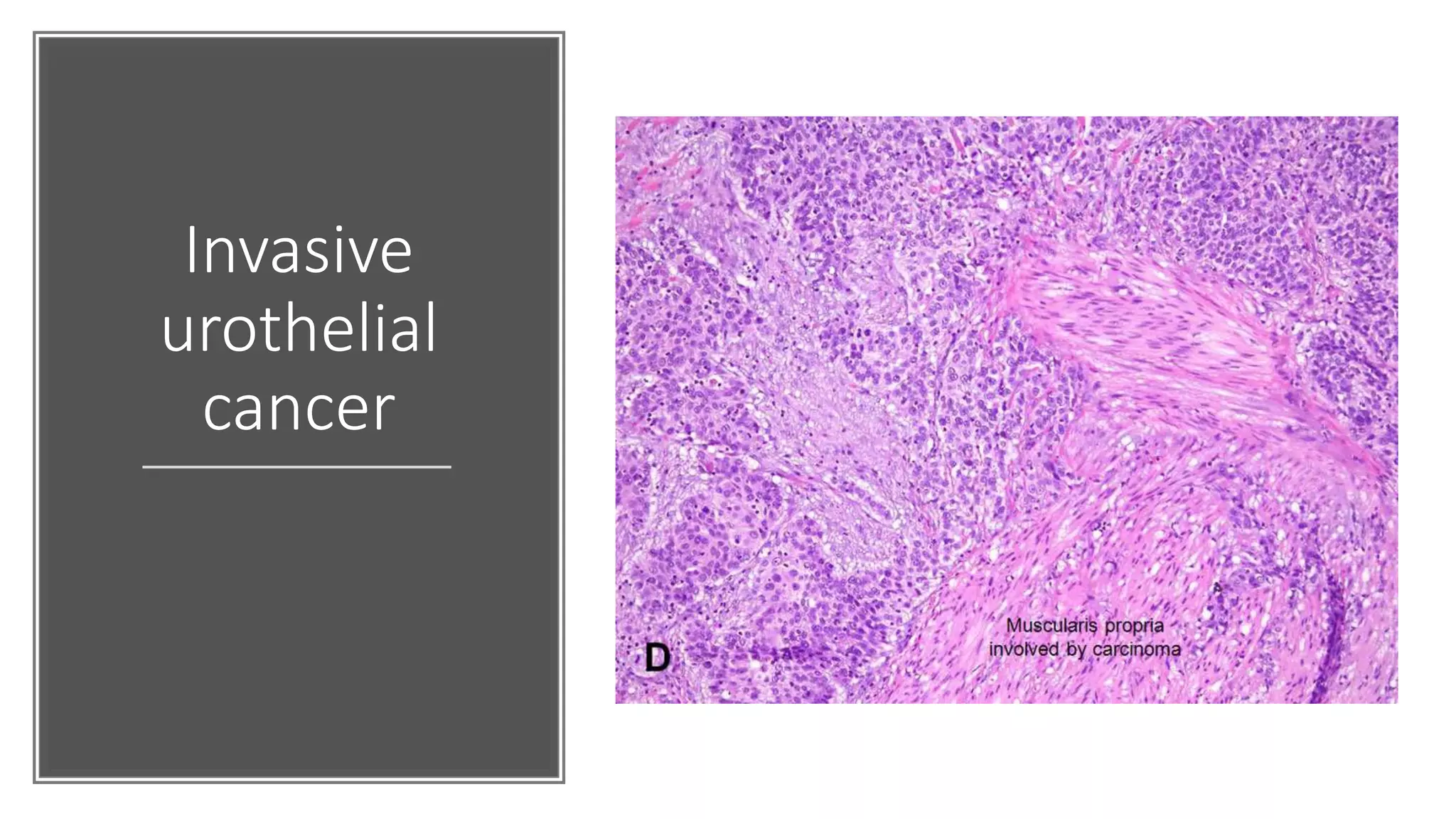 Basics of bladder tumors | PPTX