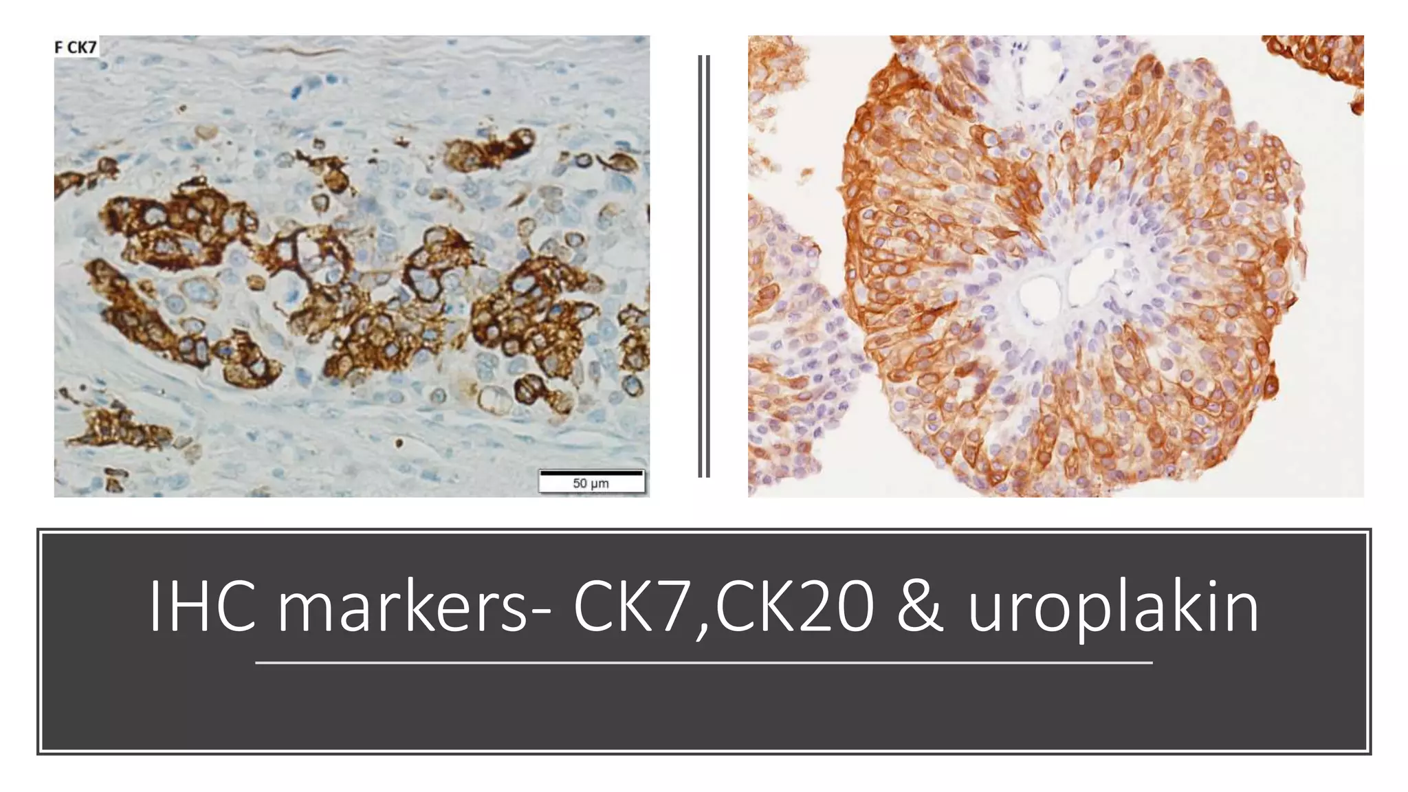 Basics of bladder tumors | PPTX