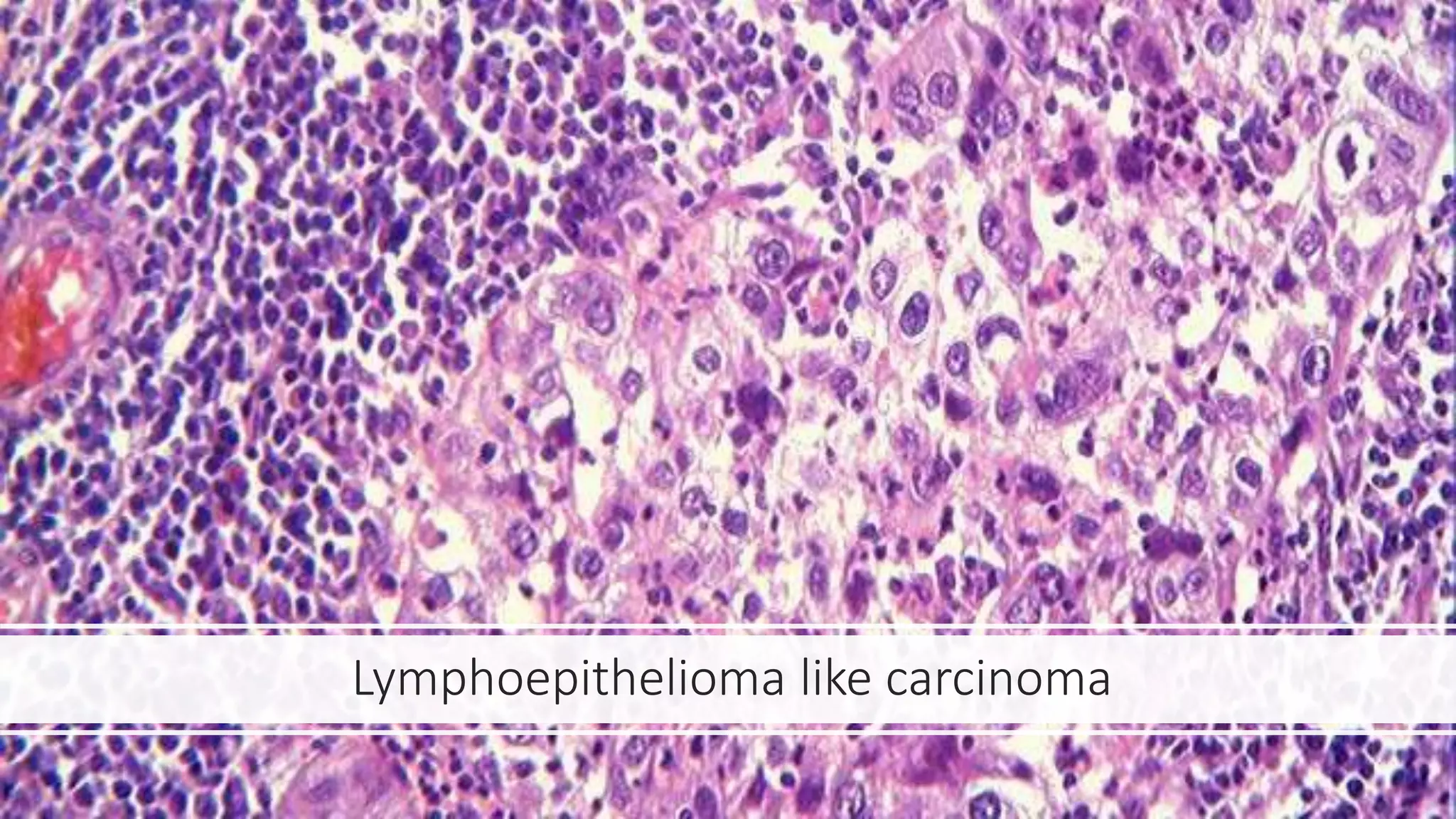 Basics of bladder tumors | PPTX