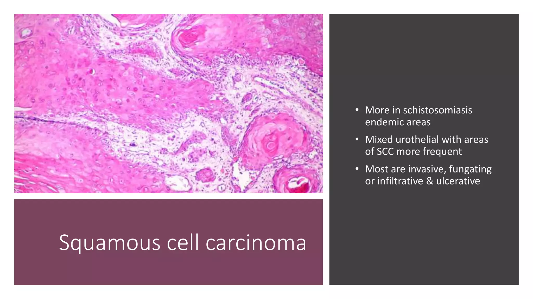 Basics of bladder tumors | PPTX