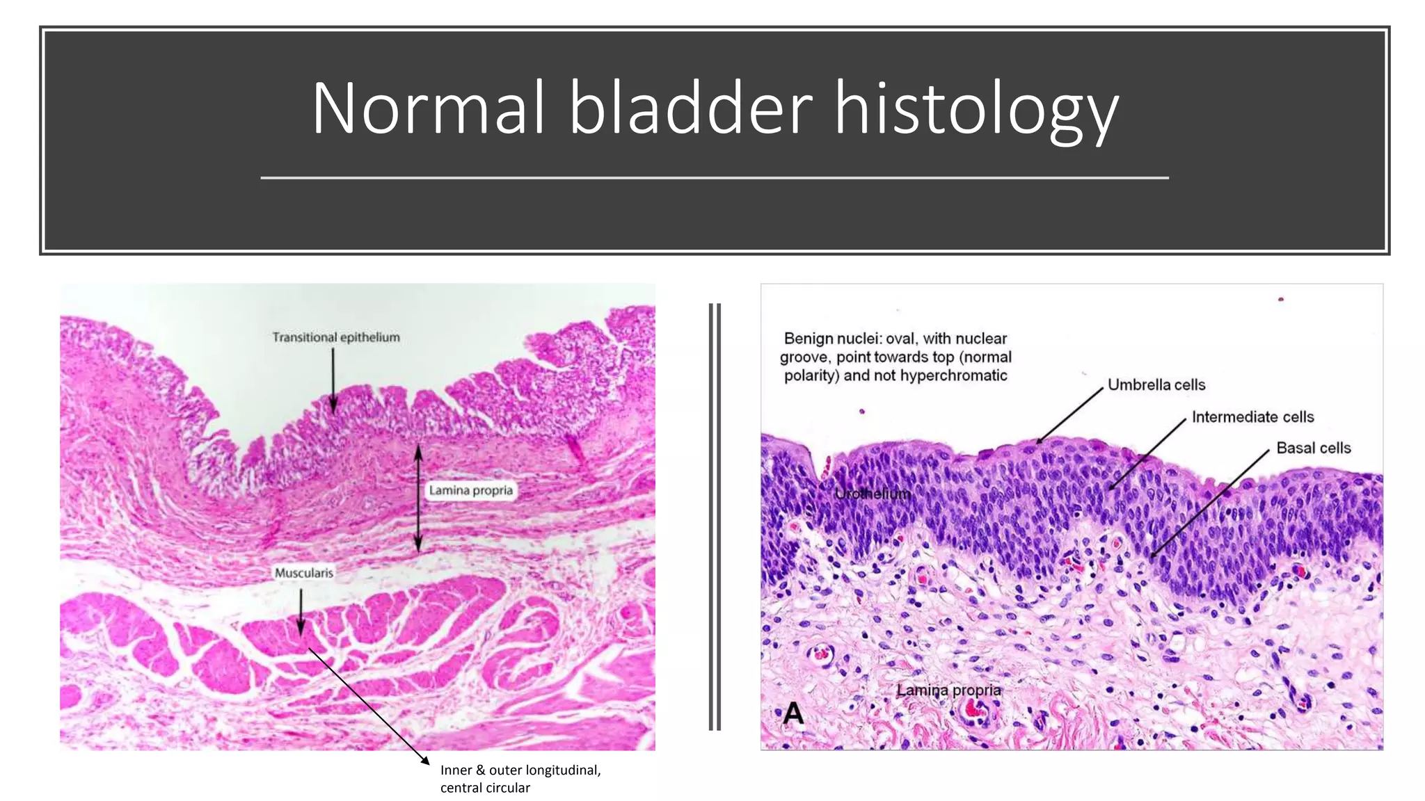 Basics of bladder tumors | PPTX