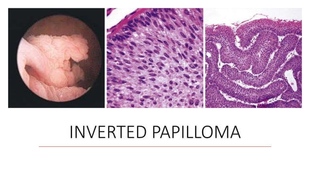 Basics of bladder tumors | PPTX | Cancer | Diseases and Conditions