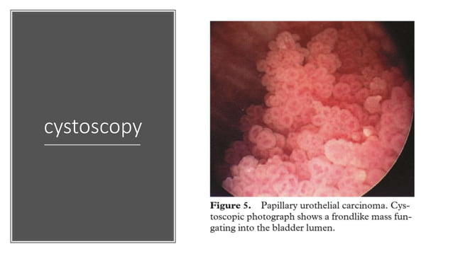 Basics of bladder tumors | PPTX | Cancer | Diseases and Conditions