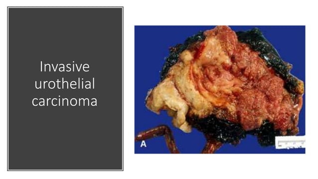 Basics of bladder tumors | PPTX | Cancer | Diseases and Conditions