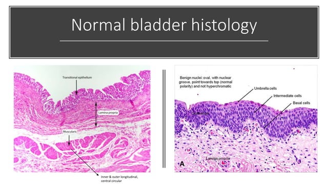 Basics of bladder tumors | PPTX | Cancer | Diseases and Conditions