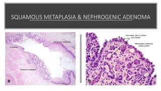 Exophytic Papilloma Of Bladder