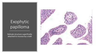 Exophytic Papilloma Of Bladder